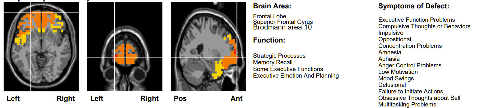 Neurofeedback Therapy San Diego - Functional Medicine Doctors